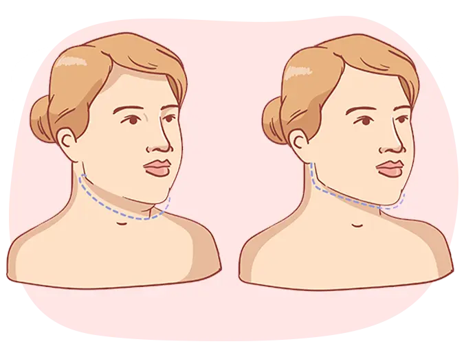 TruSculpt iD: Solutions for Non-Surgical Body Contouring